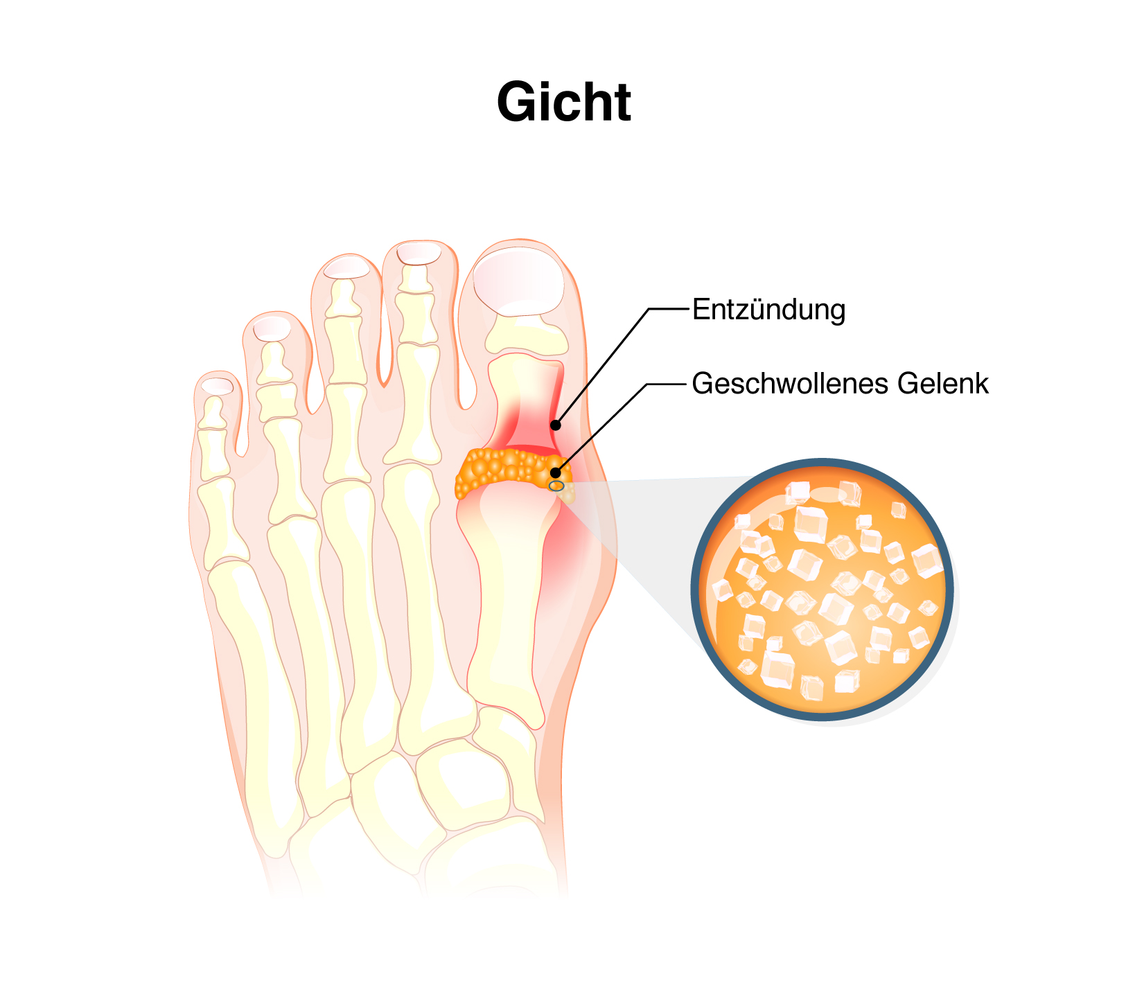 Gicht: schmerzhafte Entzündungen mit Mikronährstoffen hemmen